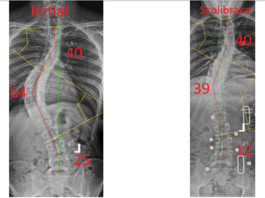 Scoliosis Degree of Curve Explanation Chart - Chiropractor in St. Augustine