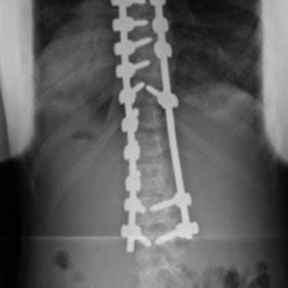 Scoliosis Surgery Rods