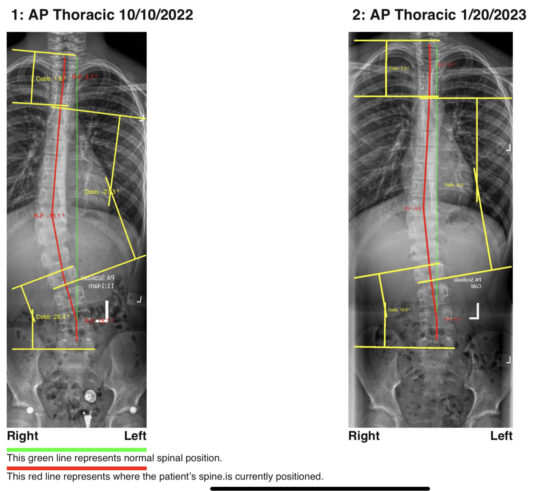 Adam's Test is a Basic Scoliosis Screening the Scoliometer is a More ...