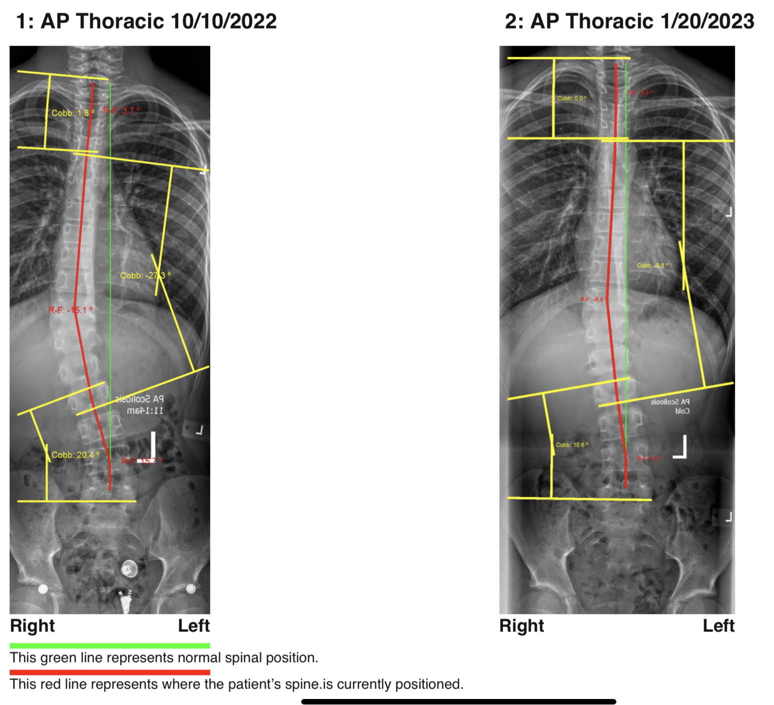 Adam's Test is a Basic Scoliosis Screening the Scoliometer is a More ...