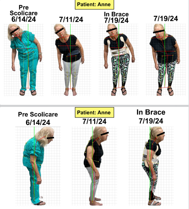 Scoliosis Degree of Curve Explanation Chart - Chiropractor in St. Augustine