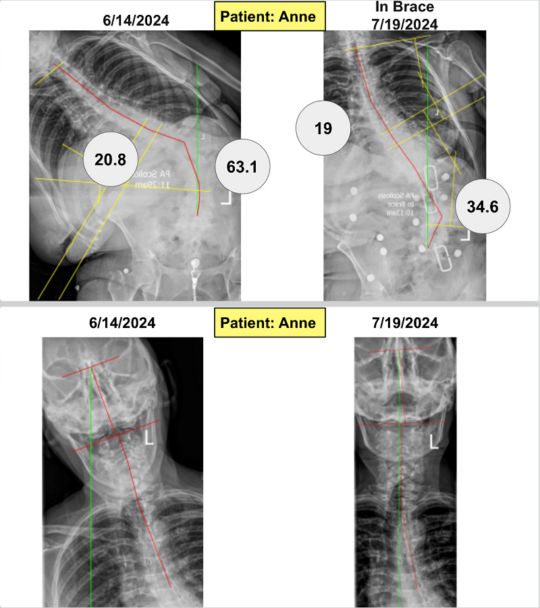 Scoliosis Degree of Curve Explanation Chart - Chiropractor in St. Augustine