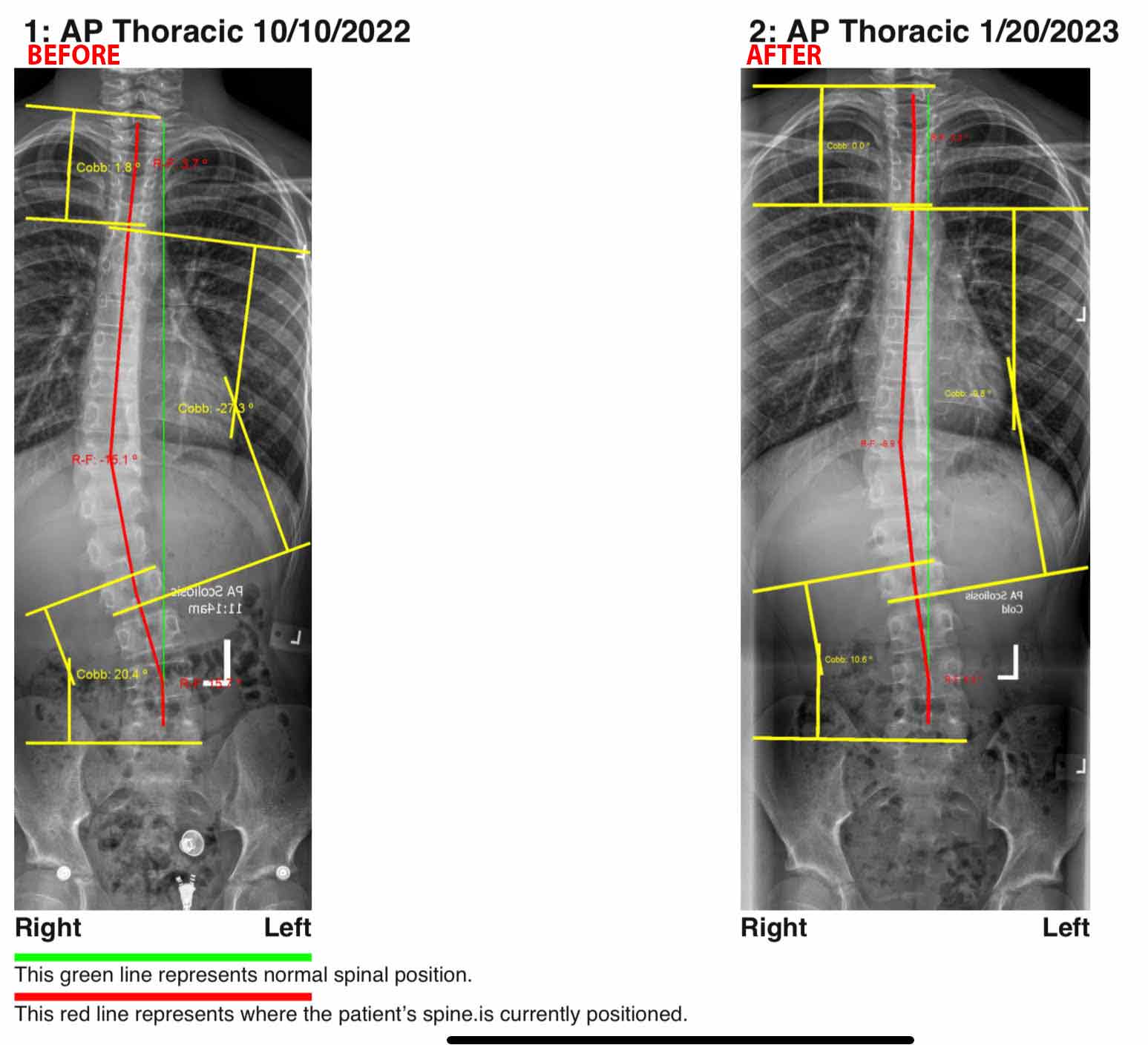 Scoliosis Degree of Curve Explanation Chart - Chiropractor in St. Augustine