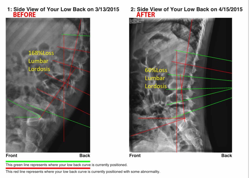 Scoliosis Degree of Curve Explanation Chart - Chiropractor in St. Augustine