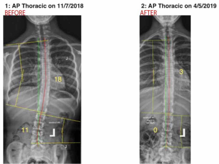 Scoliosis Degree of Curve Explanation Chart - Chiropractor in St. Augustine