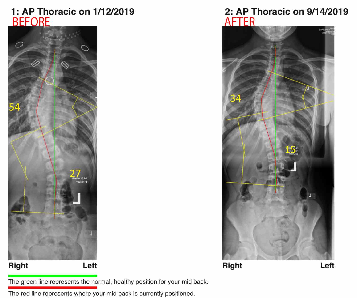 Scoliosis Degree of Curve Explanation Chart - Chiropractor in St. Augustine
